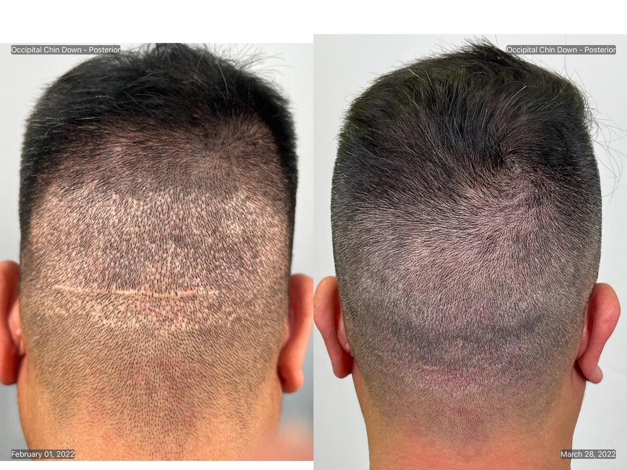 Repair Surgical Scars and Restore Hair with Strip FUE Procedure in ...