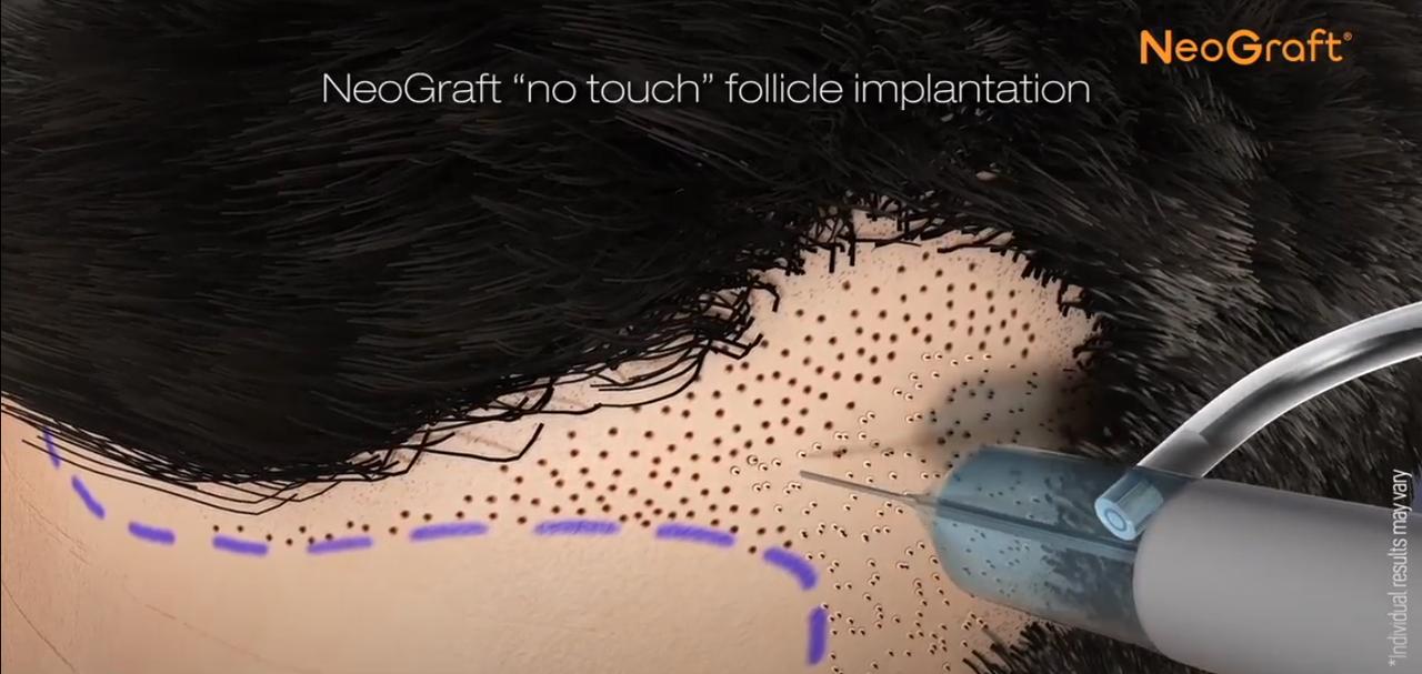 Restore Thicker, Natural Hair with NeoGraft Hair Restoration in Orlando ...
